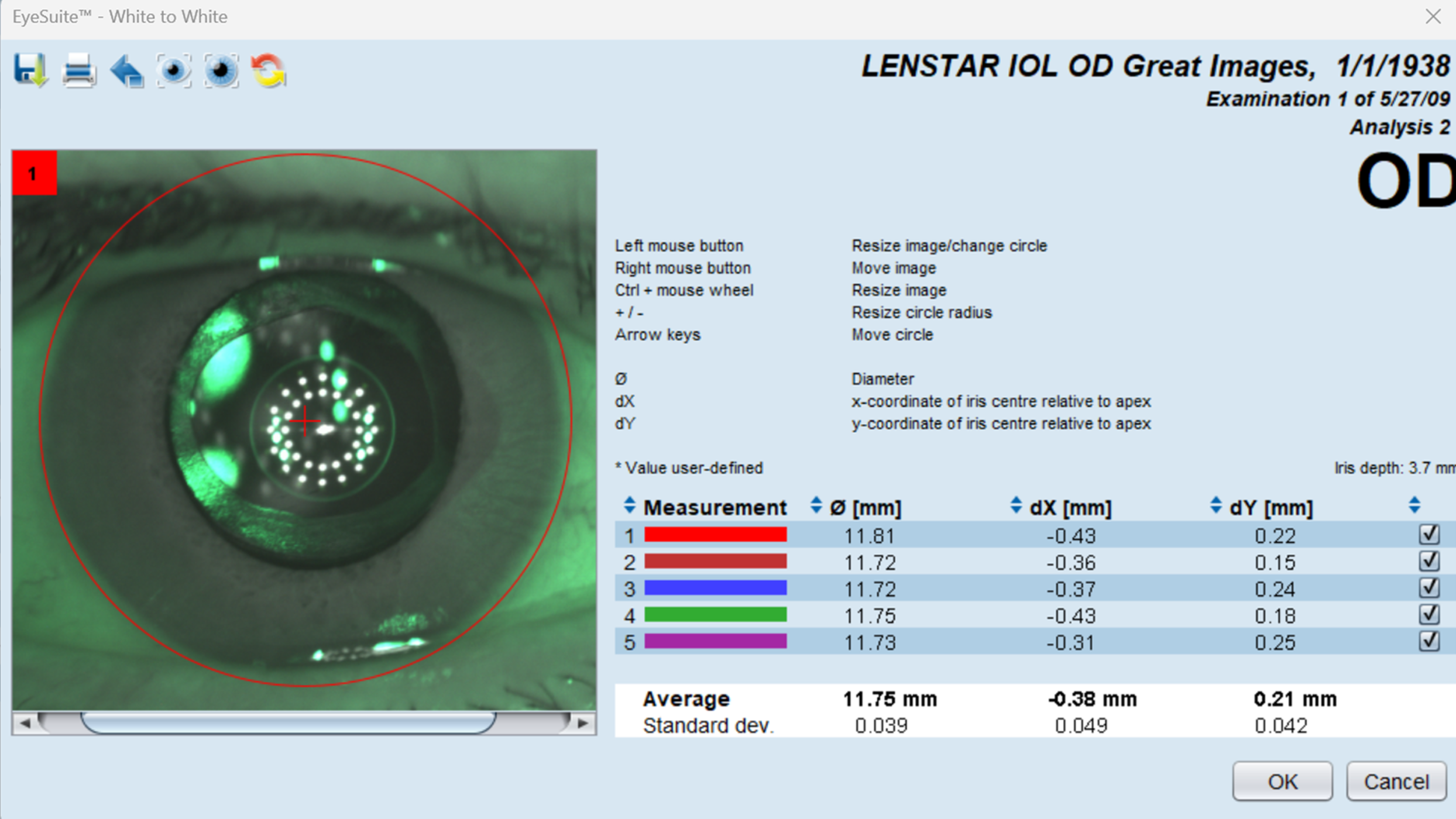 Lenstar 900 - Optical biometry